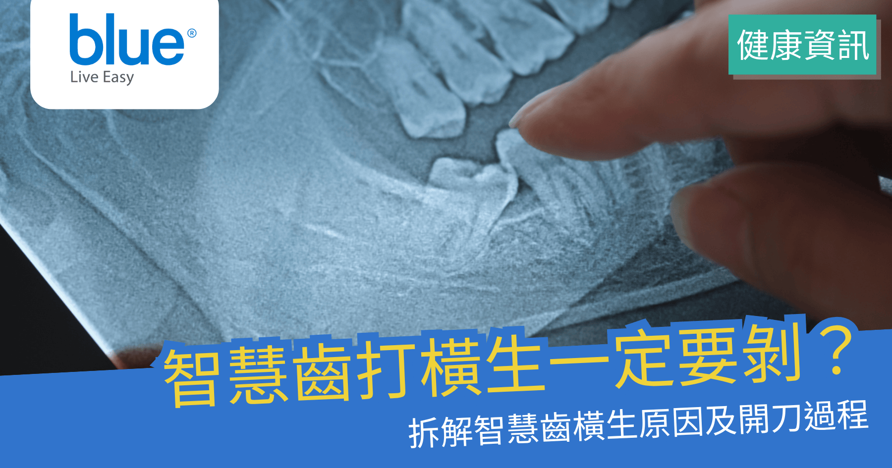 智慧齒打橫生一定要剝？詳細分析原因、影響及開刀費用 - Blue